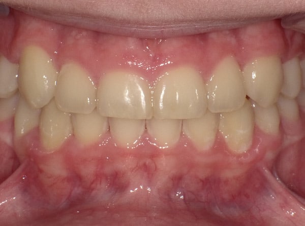 Class 1 Malocclusion Gallery | True Orthodontics, PC
