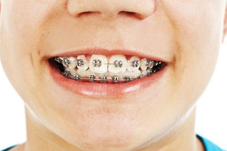 How Do I Know If I Need Braces? | True Orthodontics, PC