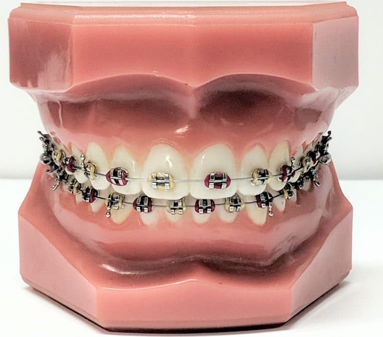 Metal, Clear and Ceramic Braces. What’s the Difference? | True ...